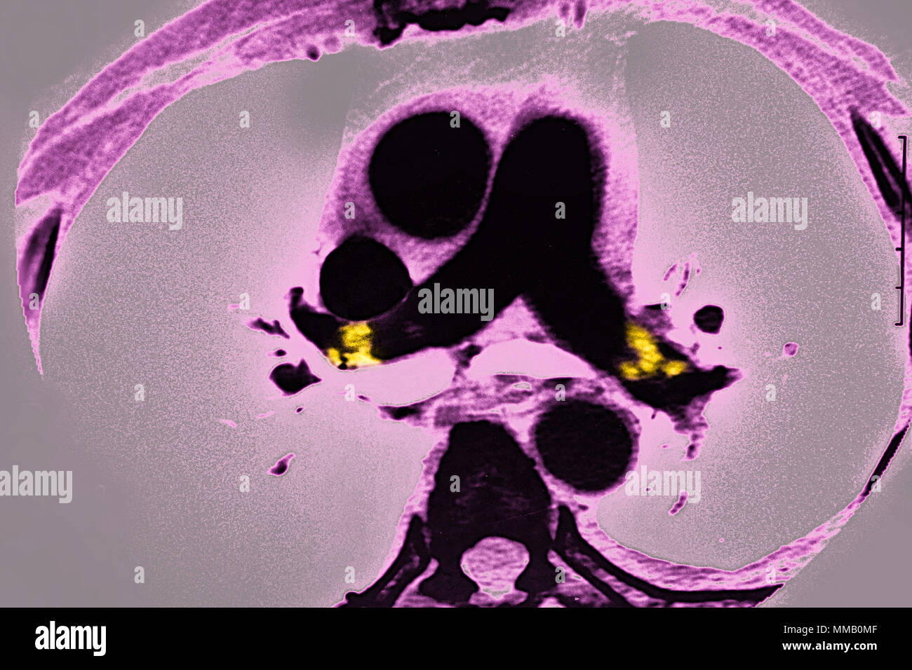 Computer Assisted Tomography Stockfotos & Computer Assisted Tomography ...