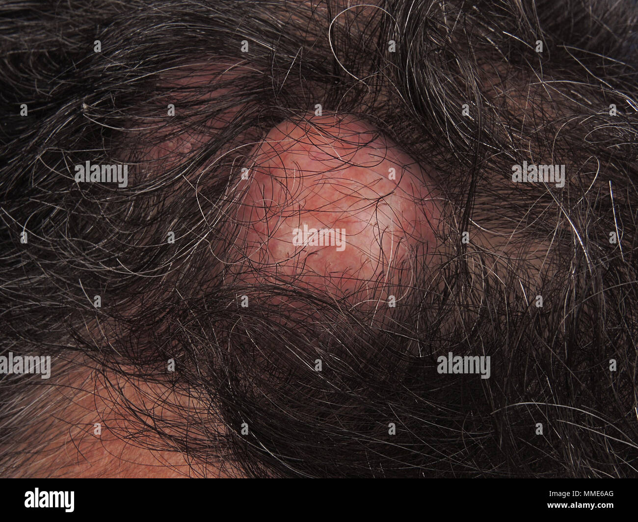 Pilar zyste -Fotos und -Bildmaterial in hoher Auflösung – Alamy