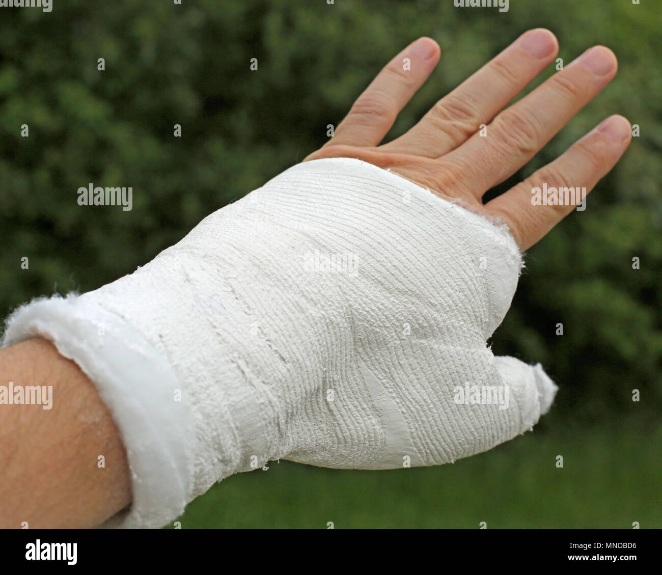 Die Hand mit dem Weißen medizinische Cast verletzt nach dem Bruch der ...