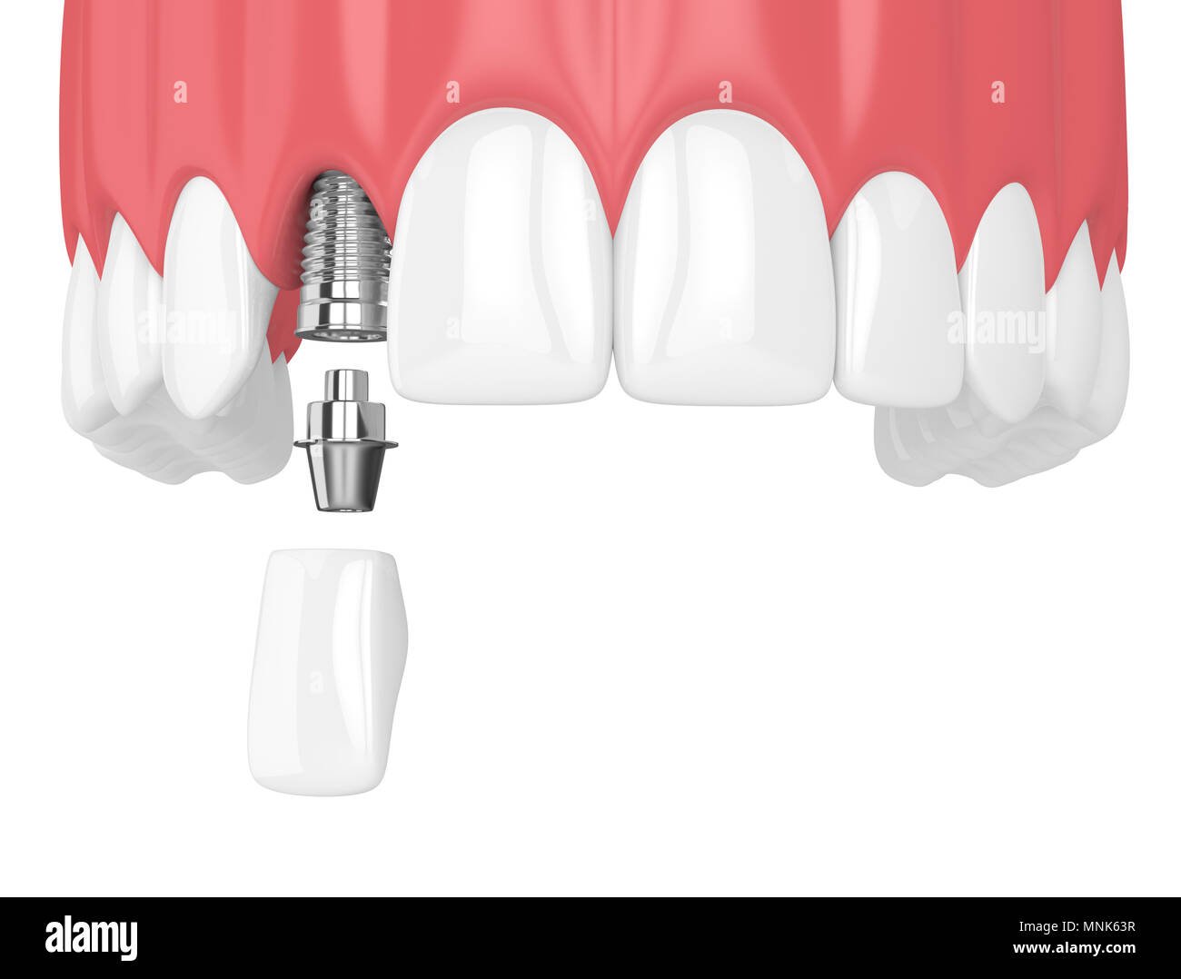 Lateral Incisor Stockfotos und -bilder Kaufen - Alamy