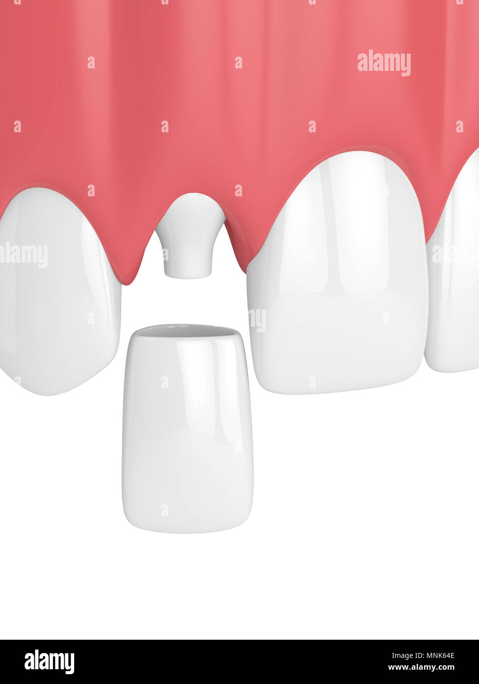 Lateral Incisor Stockfotos und -bilder Kaufen - Alamy