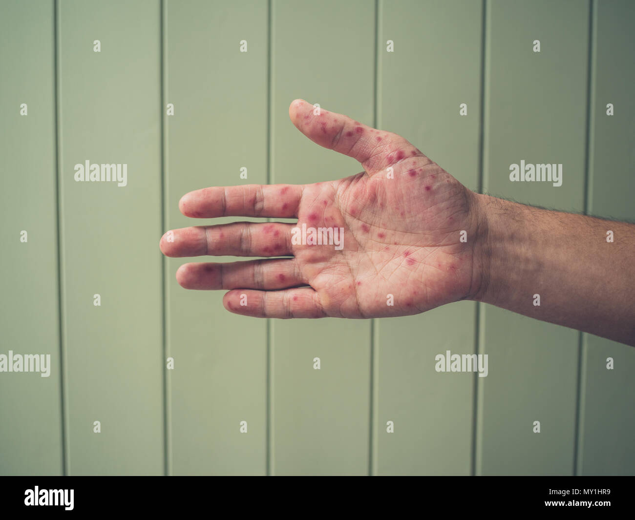 Masern ausschlag -Fotos und -Bildmaterial in hoher Auflösung – Alamy