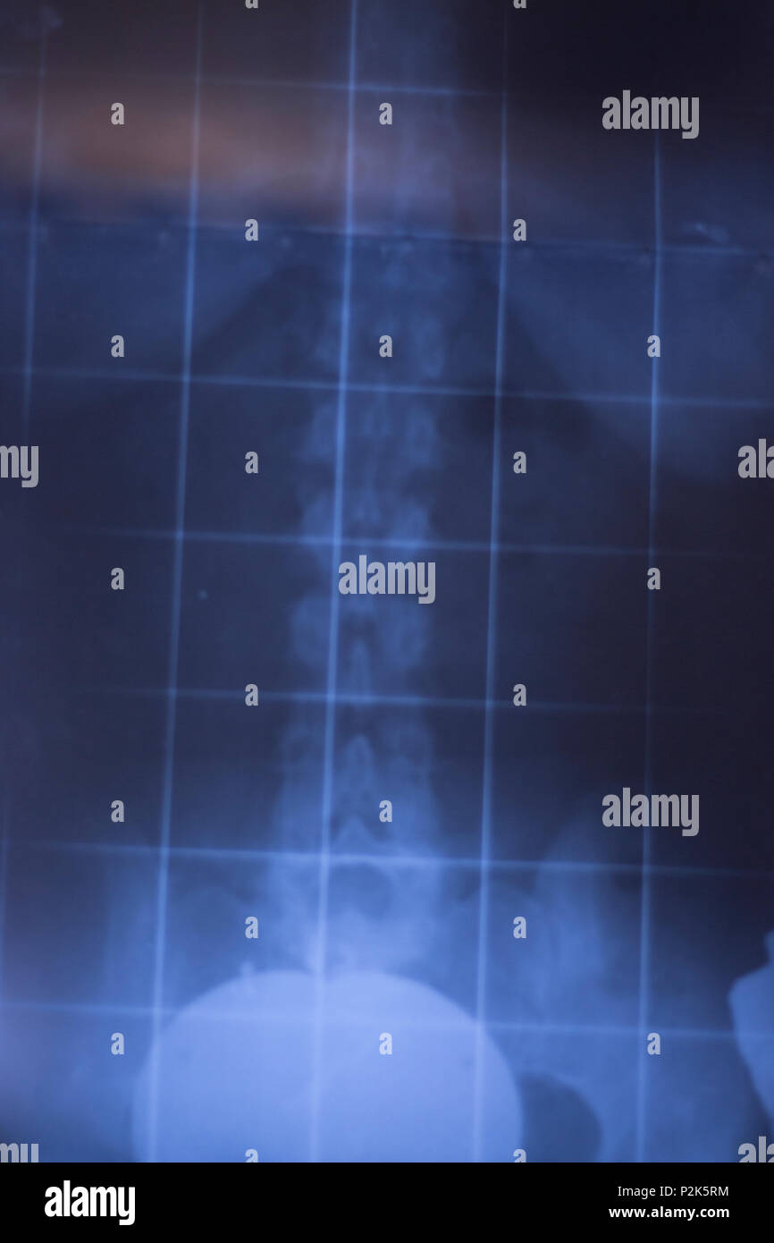 Medizinische Klinik x-ray Lowe Rückenschmerzen Wirbelsäule und Hüfte ...