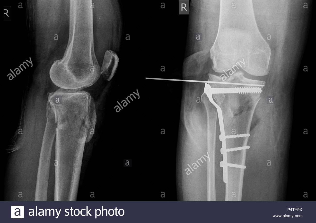 Proximale Tibia Stockfotos & Proximale Tibia Bilder - Alamy