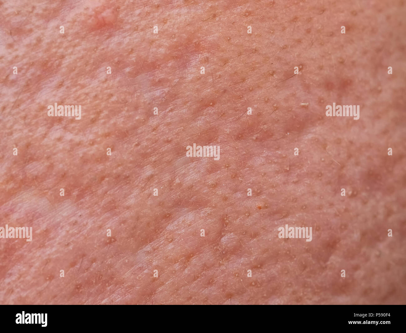 Hautprobleme im gesicht -Fotos und -Bildmaterial in hoher Auflösung – Alamy