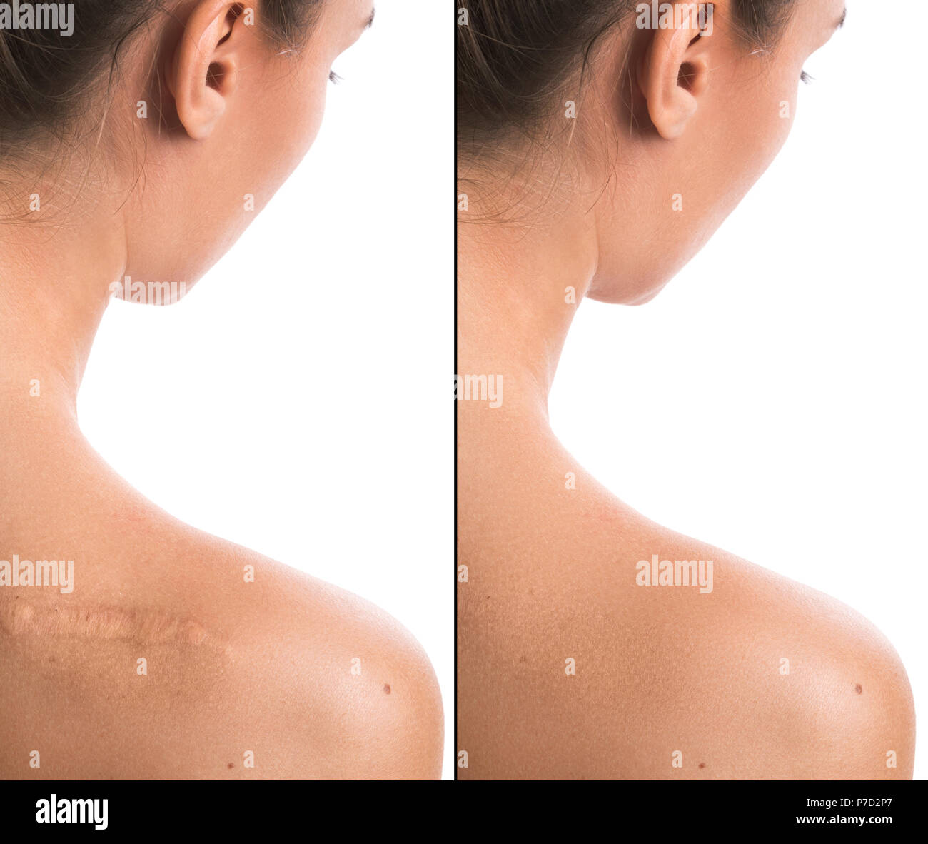 Scar tissue -Fotos und -Bildmaterial in hoher Auflösung - Seite 2 - Alamy