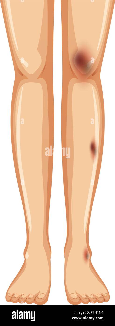 Blaue flecken Stock-Vektorgrafiken kaufen - Alamy