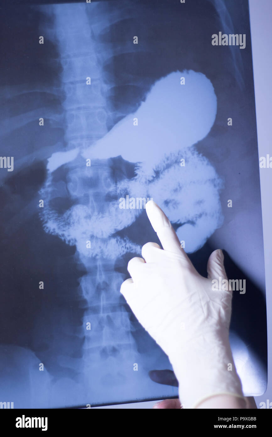 Medizinische Klinik x-ray Lowe Rückenschmerzen Wirbelsäule und Hüfte ...