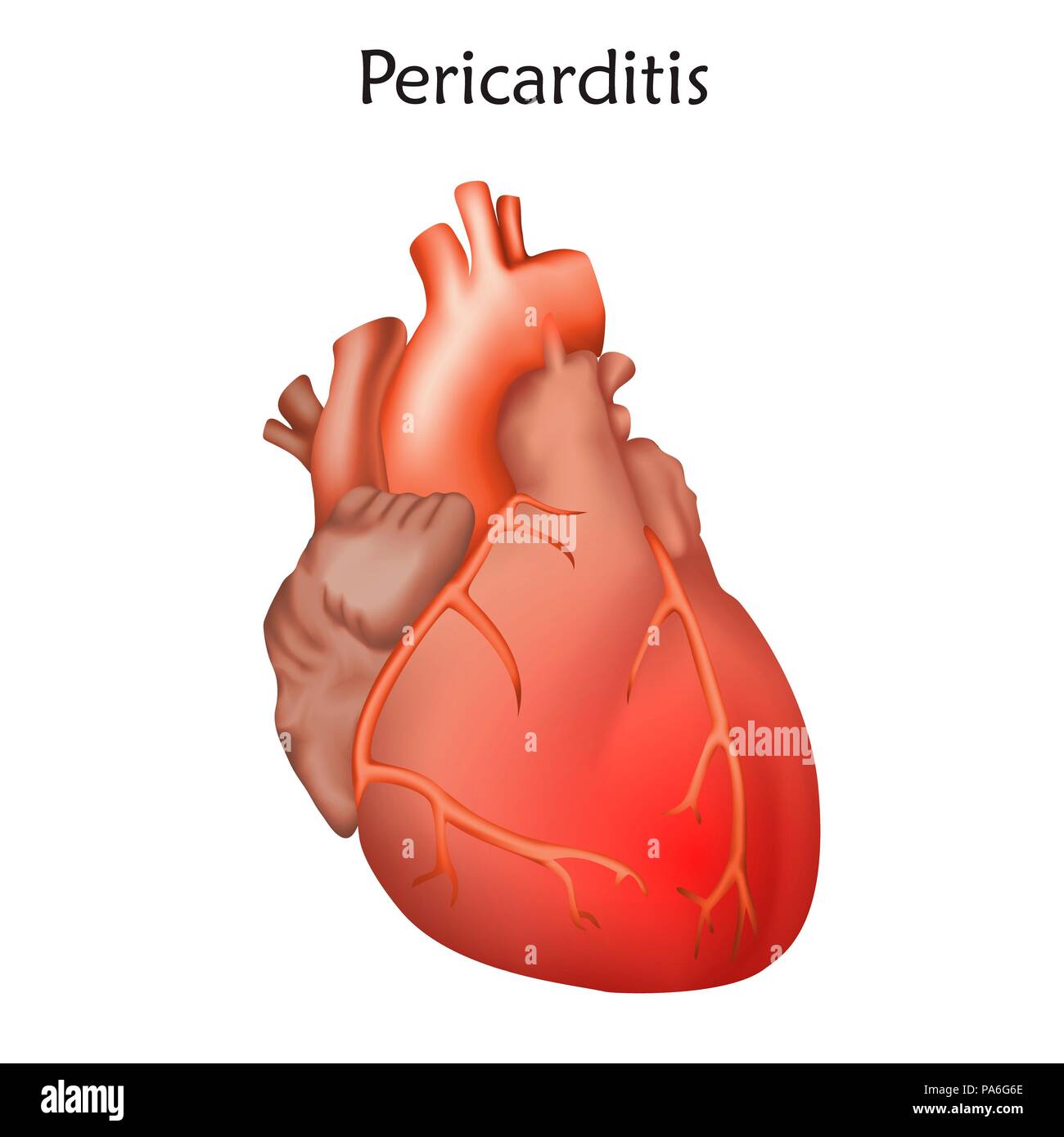 Rheumatische perikarditis -Fotos und -Bildmaterial in hoher Auflösung ...
