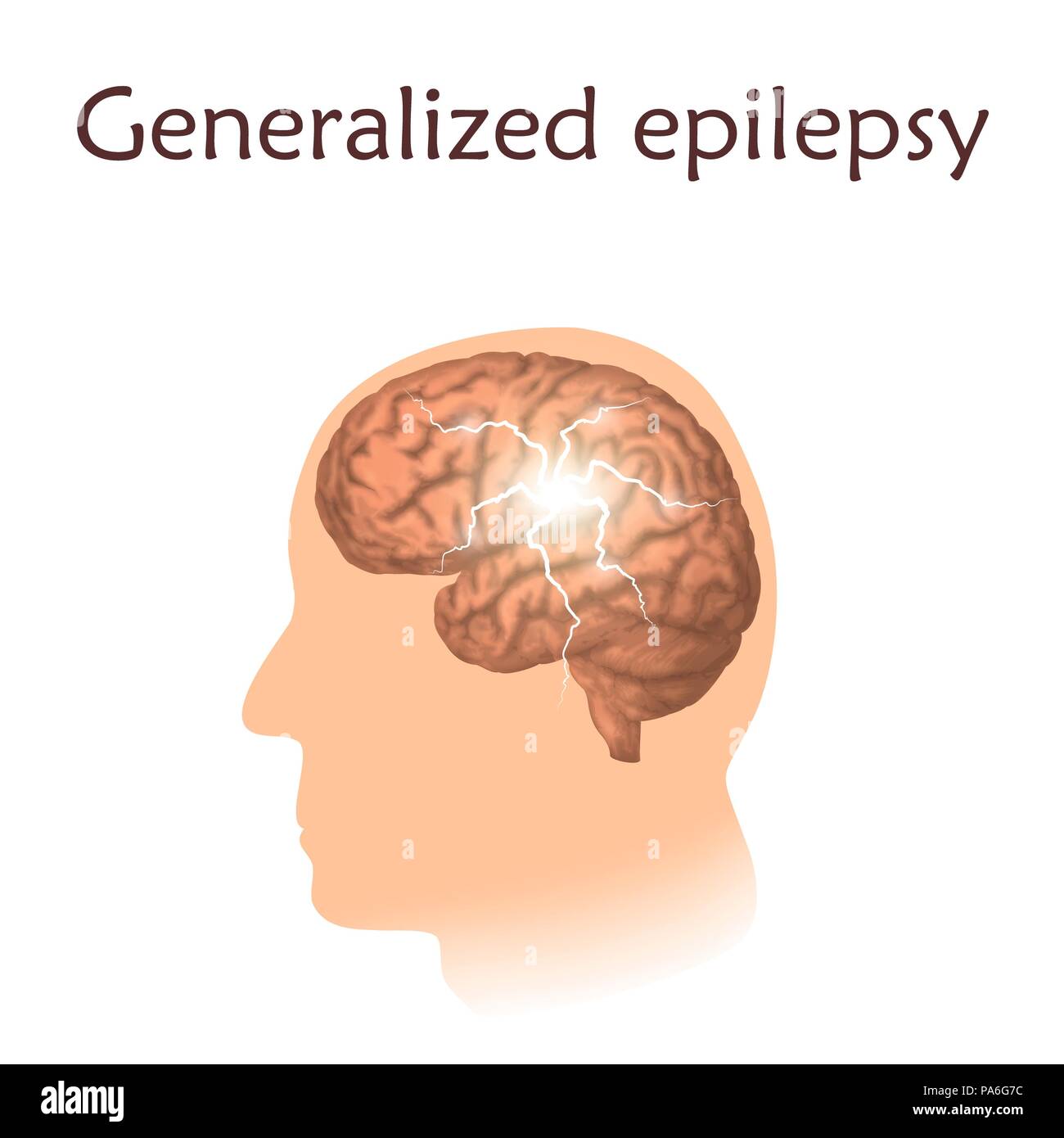Generalisierte Epilepsie, Illustration. Elektrische im gesamten Gehirn ...