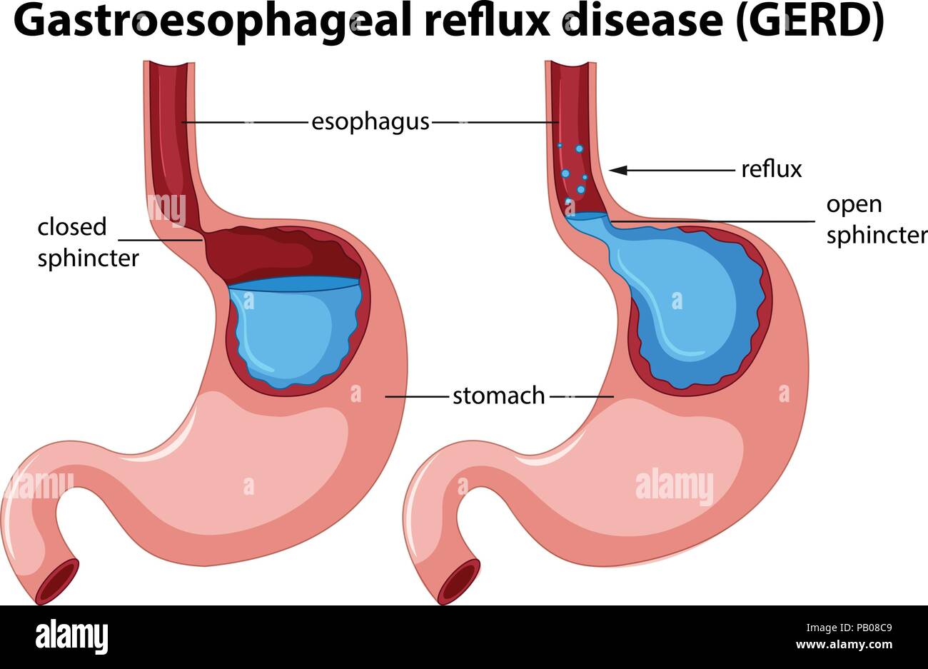 Gastroösophageale Refluxkrankheit Anatomie illustration Stock ...