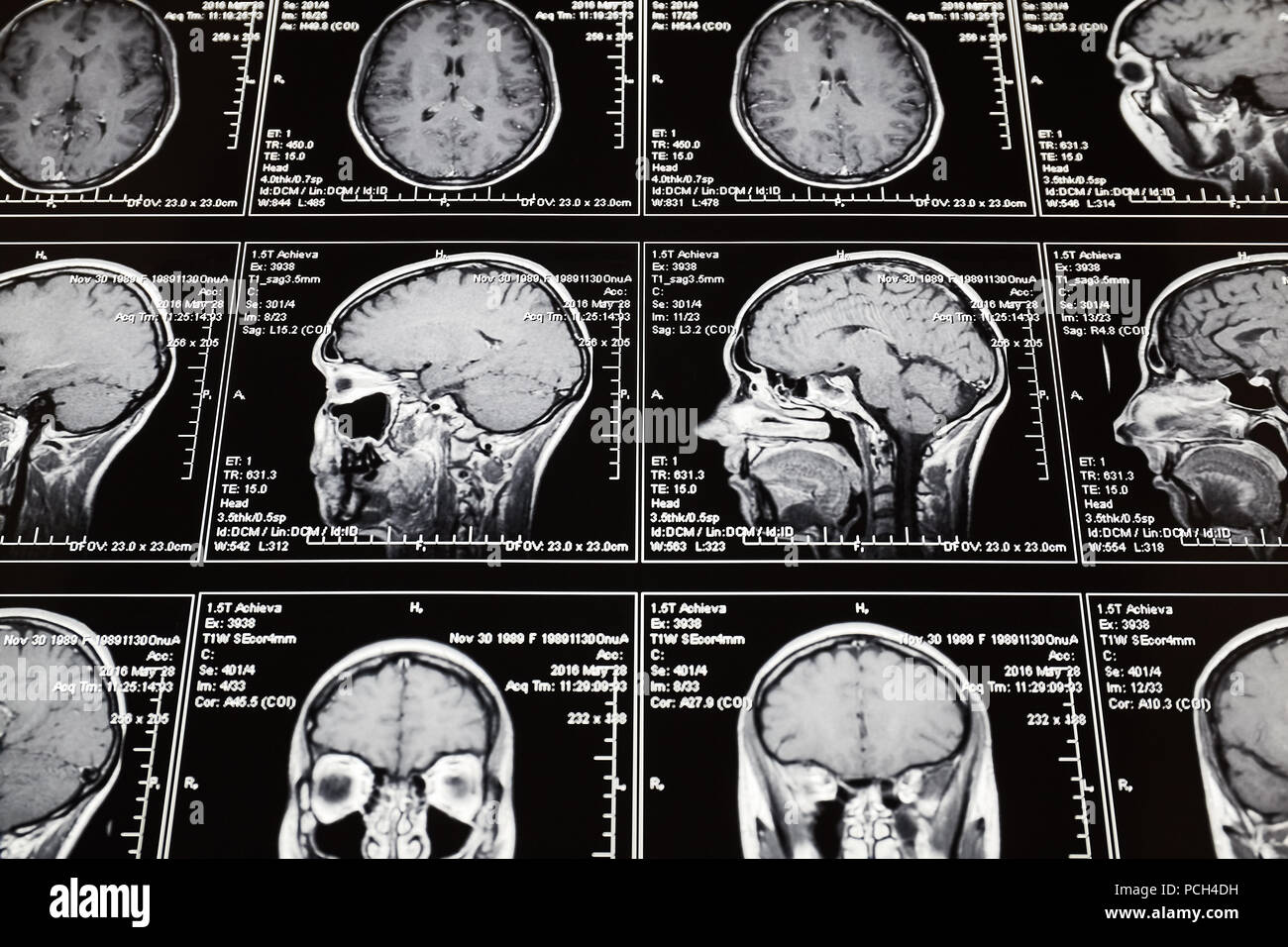 Mrt-Scan des Gehirns. MRI-Scan Stockfotografie - Alamy