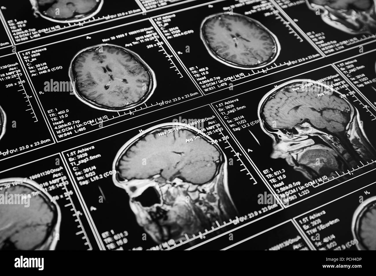 Mrt-Scan des Gehirns. MRI-Scan Stockfotografie - Alamy