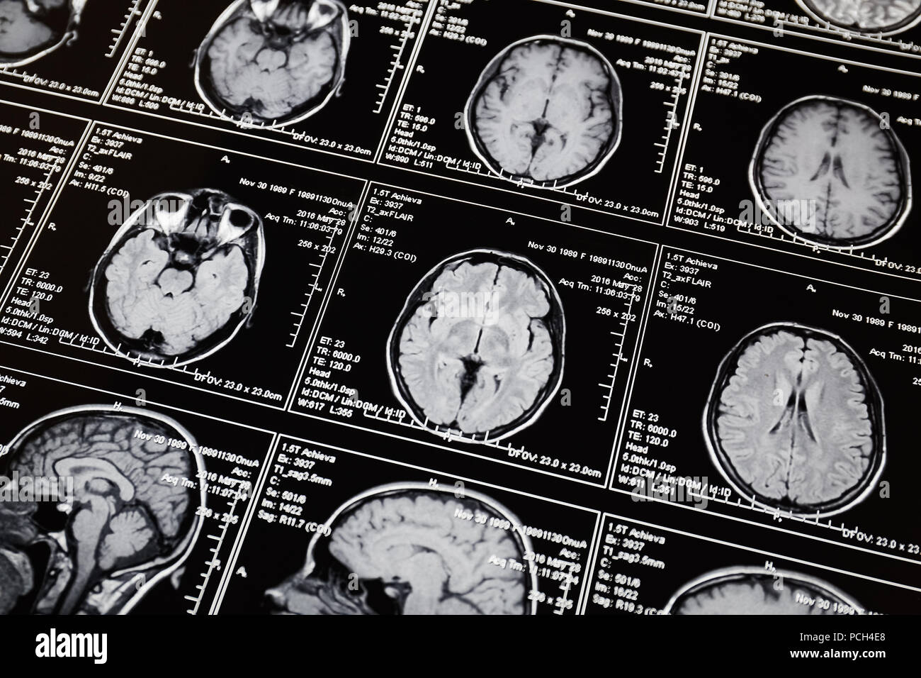 Mrt-Scan des Gehirns. MRI-Scan Stockfotografie - Alamy