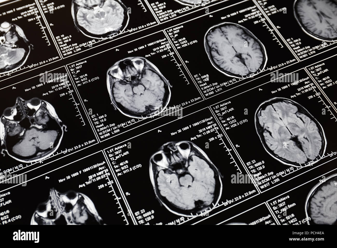 Mrt-Scan des Gehirns. MRI-Scan Stockfotografie - Alamy