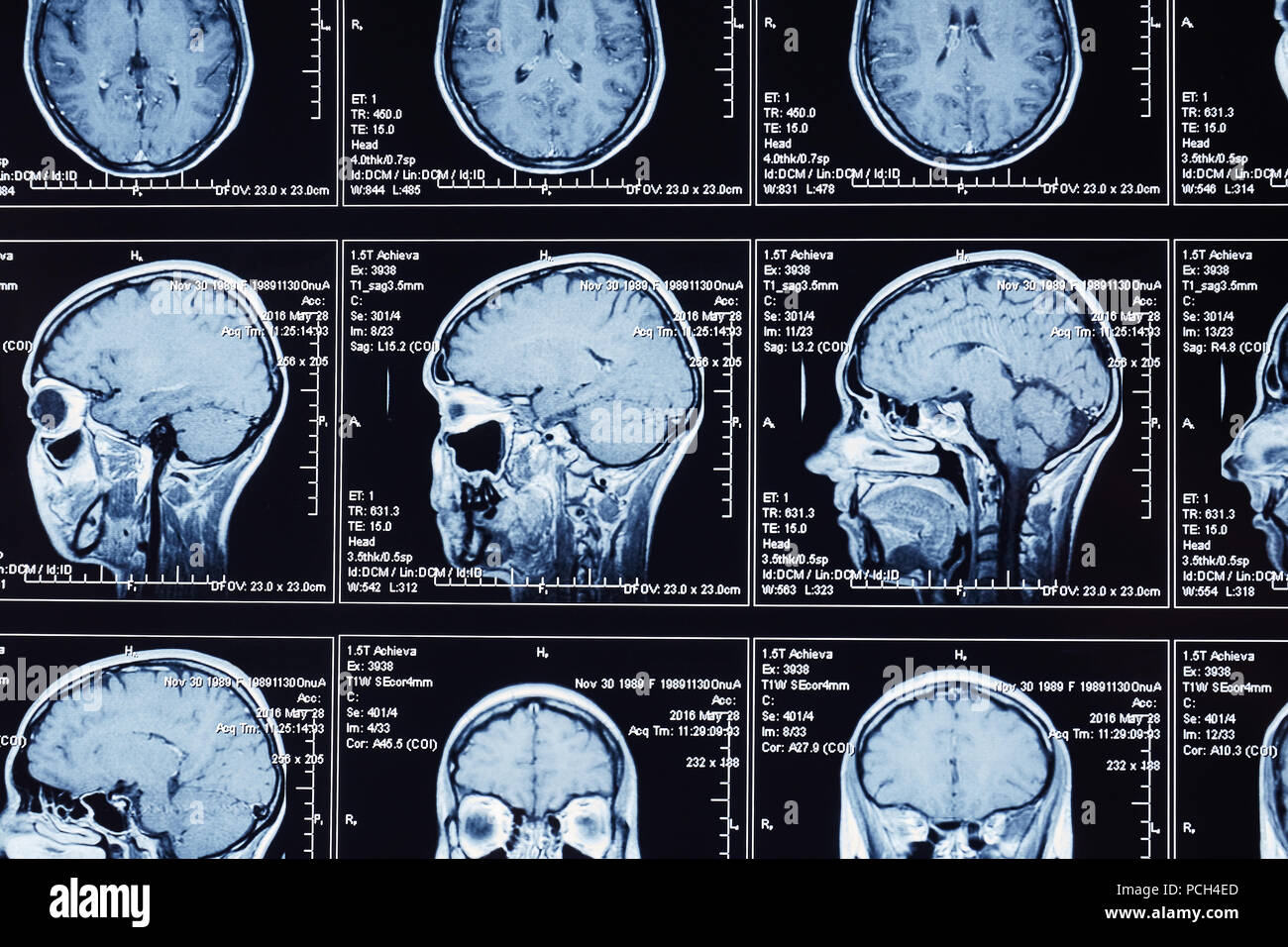 Mrt-Scan des Gehirns. MRI-Scan Stockfotografie - Alamy