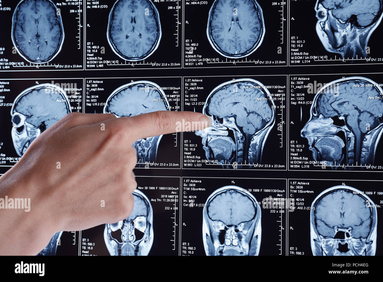 Mrt-Scan des Gehirns. MRI-Scan Stockfotografie - Alamy