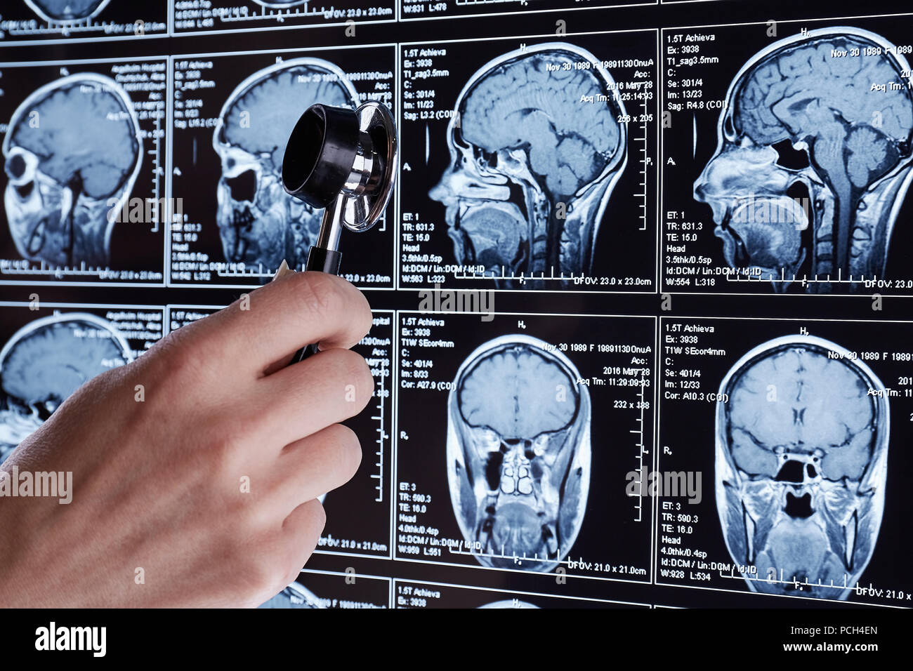 Mrt-Scan des Gehirns. MRI-Scan Stockfotografie - Alamy
