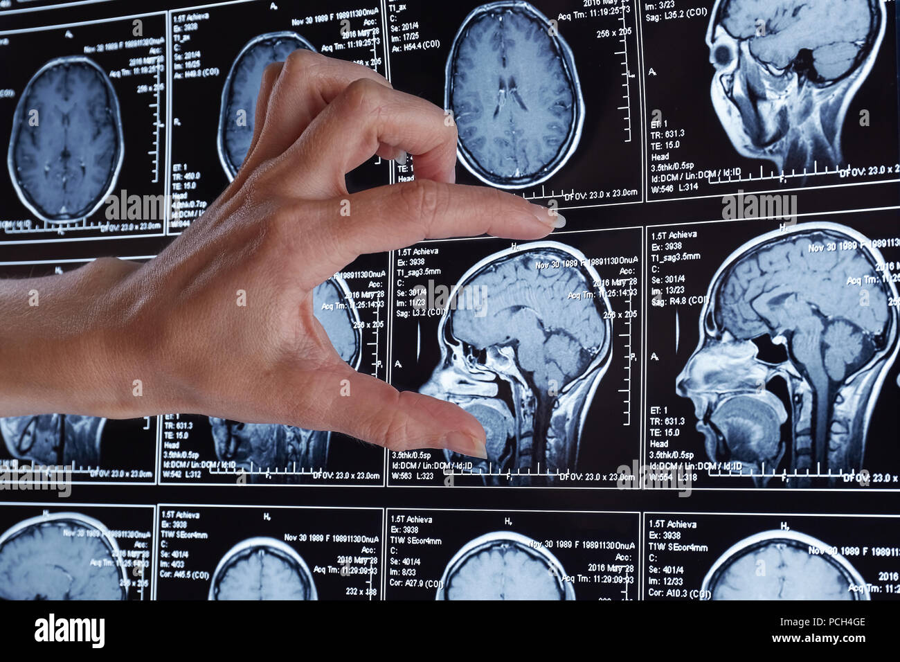Mrt-Scan des Gehirns. MRI-Scan Stockfotografie - Alamy
