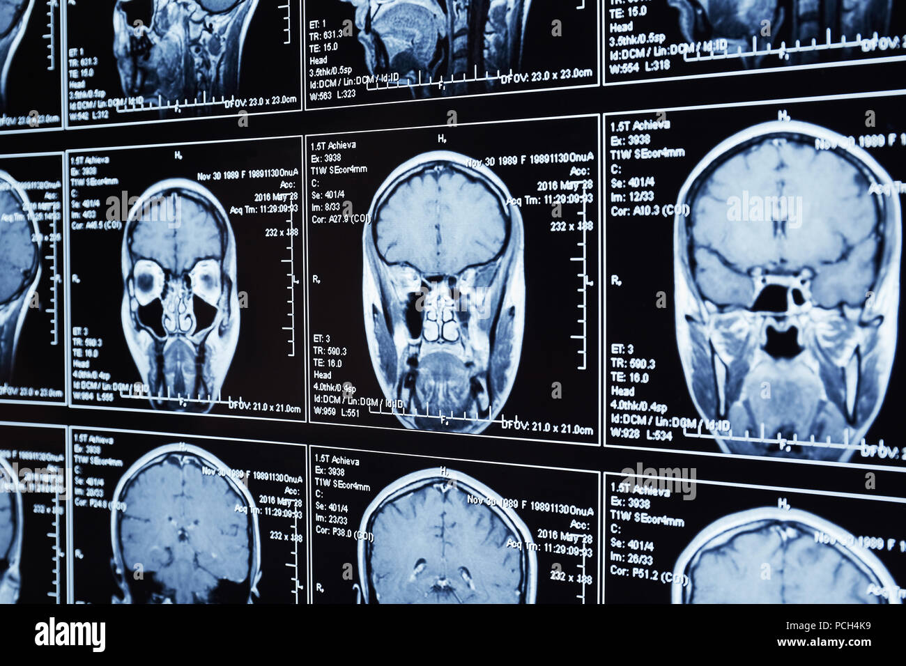 Mrt-Scan des Gehirns. MRI-Scan Stockfotografie - Alamy