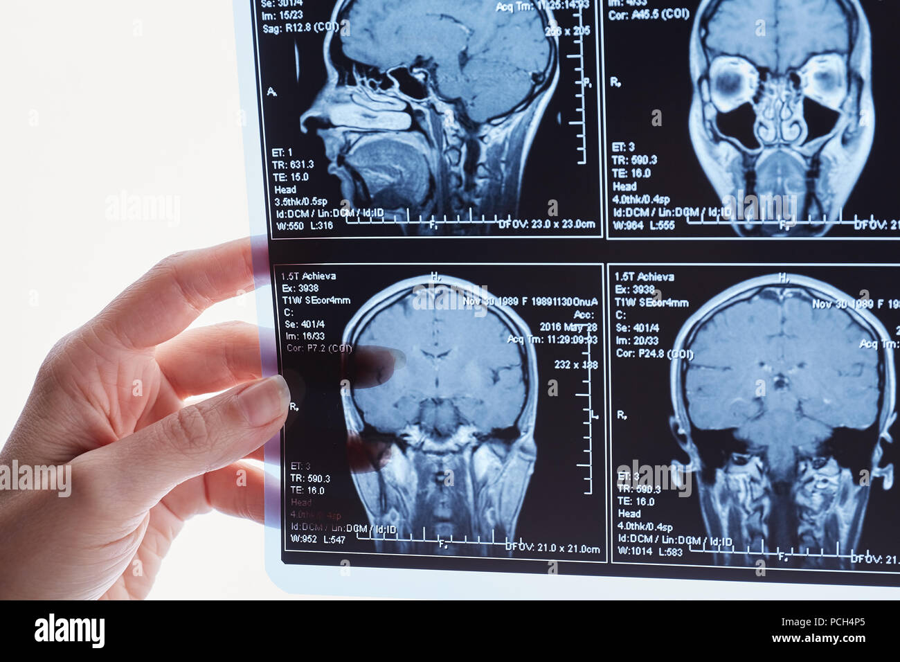 Mrt-Scan des Gehirns. MRI-Scan Stockfotografie - Alamy