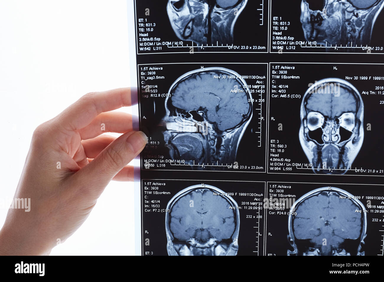 Mrt-Scan des Gehirns. MRI-Scan Stockfotografie - Alamy
