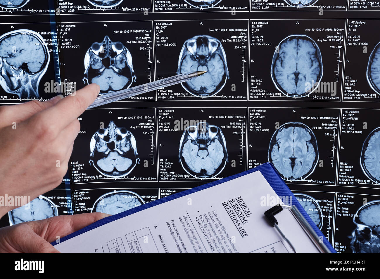 Mrt-Scan des Gehirns. MRI-Scan Stockfotografie - Alamy