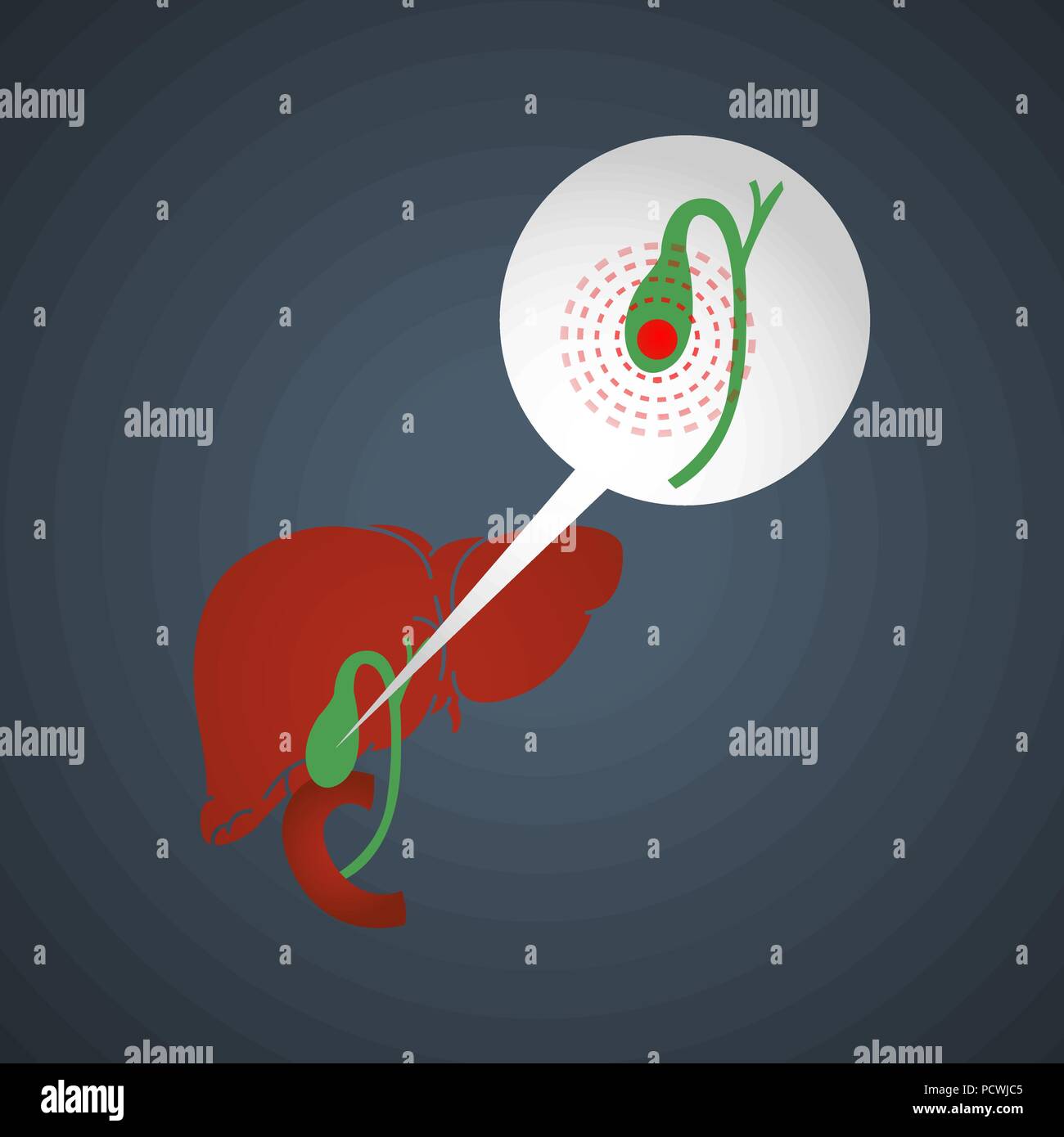 Gallenblasenentzündung Cholezystitis Stockfotos und -bilder Kaufen - Alamy