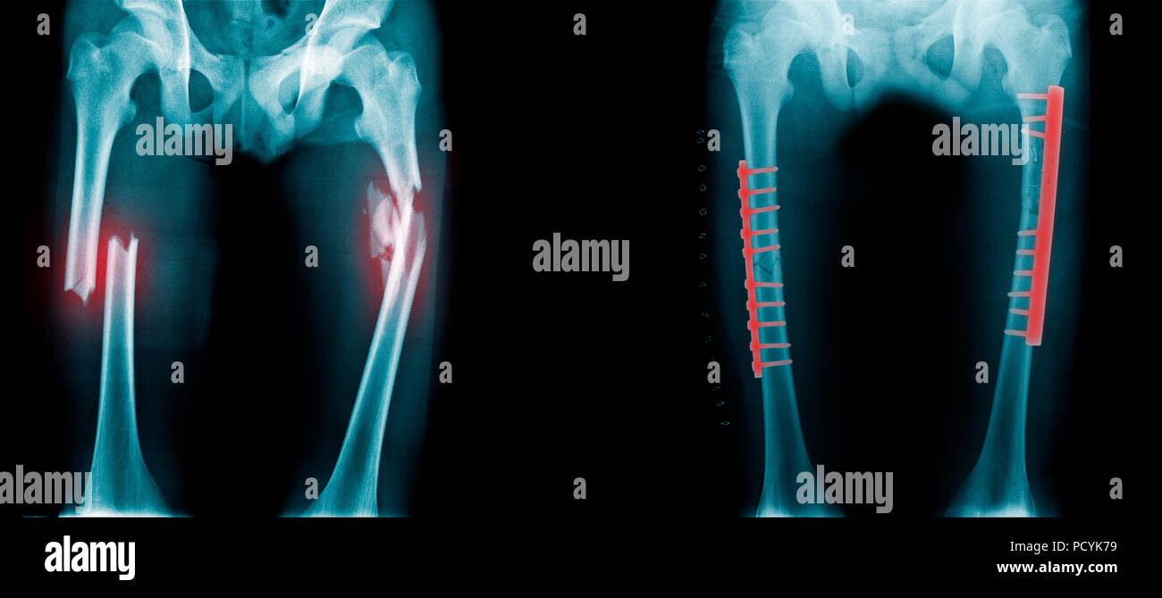 Oberschenkelknochen hals -Fotos und -Bildmaterial in hoher Auflösung – Alamy