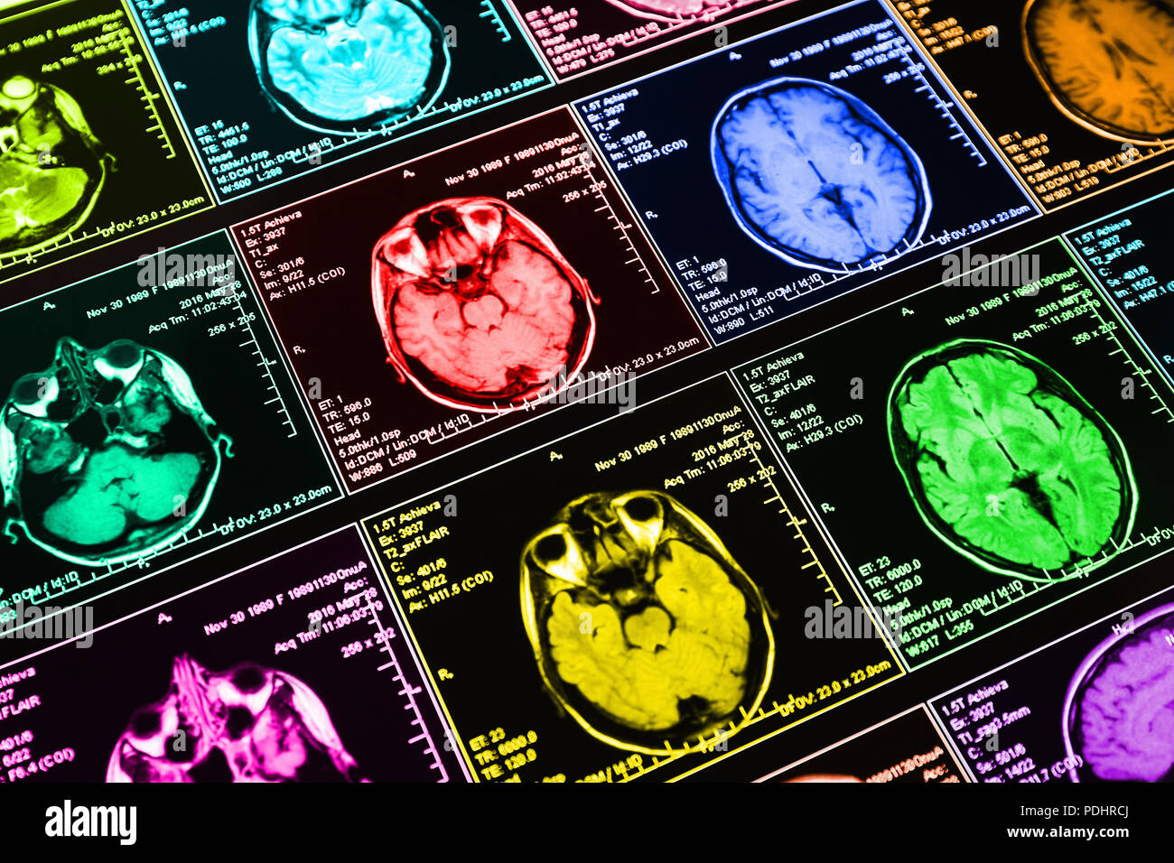 Mrt-Scan des Gehirns. MRI-Scan Stockfotografie - Alamy