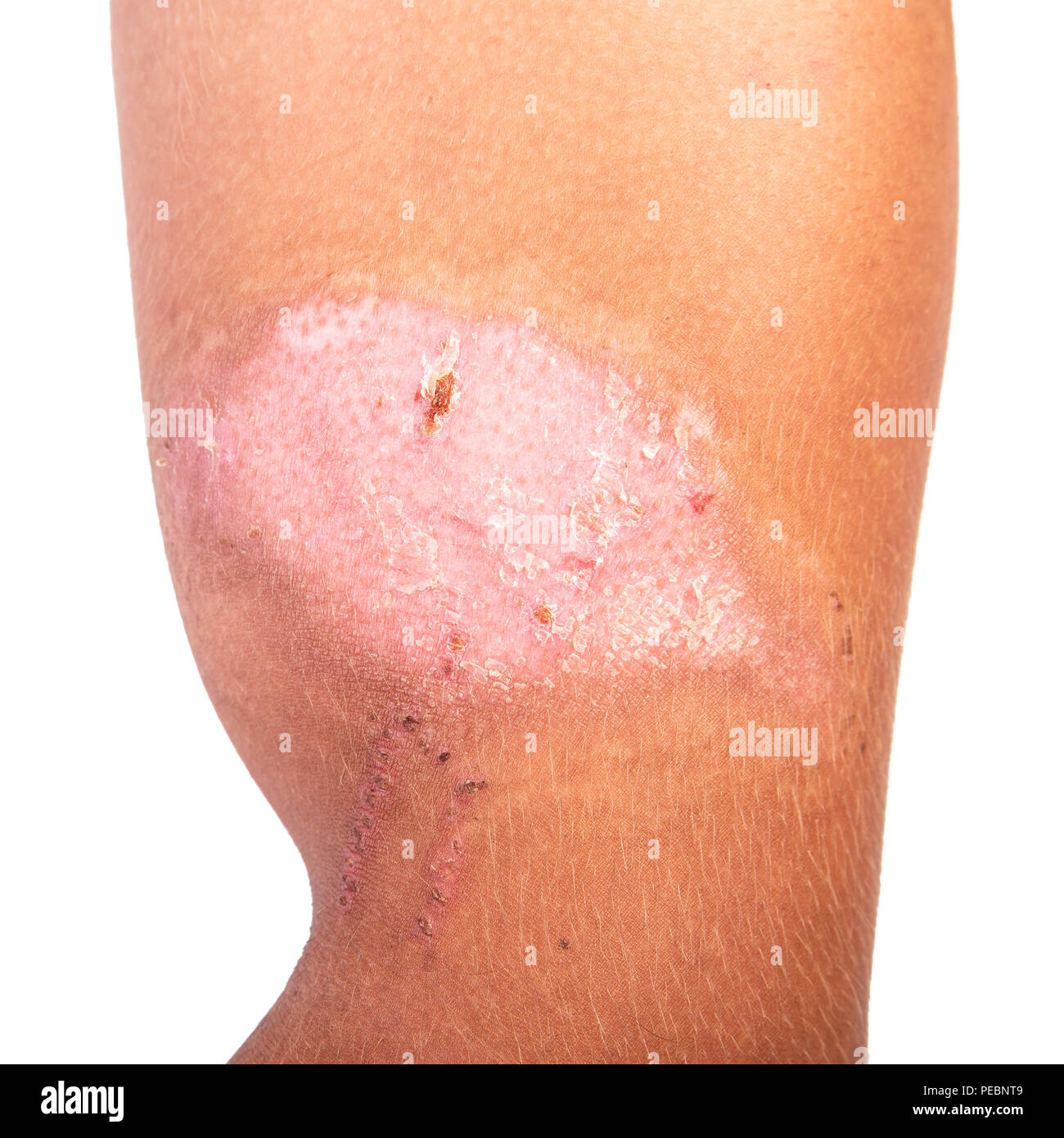 Burn wound -Fotos und -Bildmaterial in hoher Auflösung – Alamy