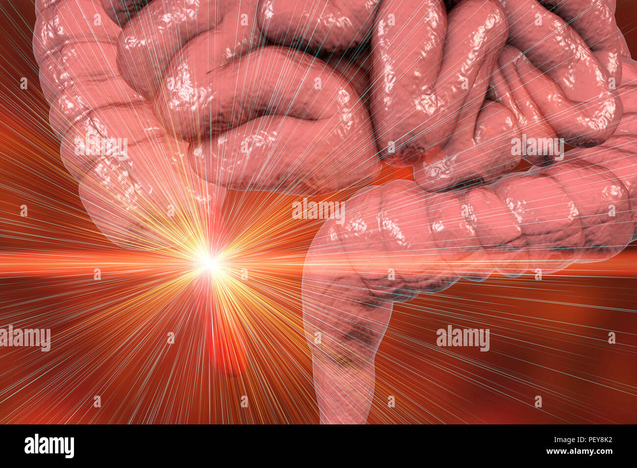 Akute appendizitis -Fotos und -Bildmaterial in hoher Auflösung – Alamy