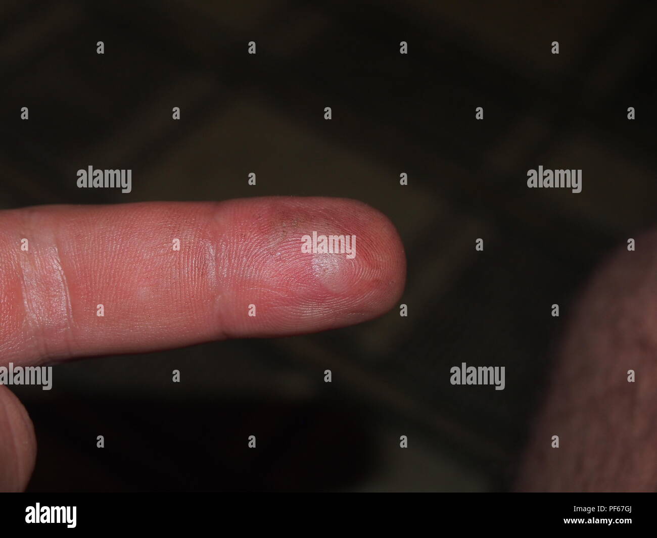 Verbrennungen auf der Haut der Finger. Blasen auf der Haut. Verletzung ...