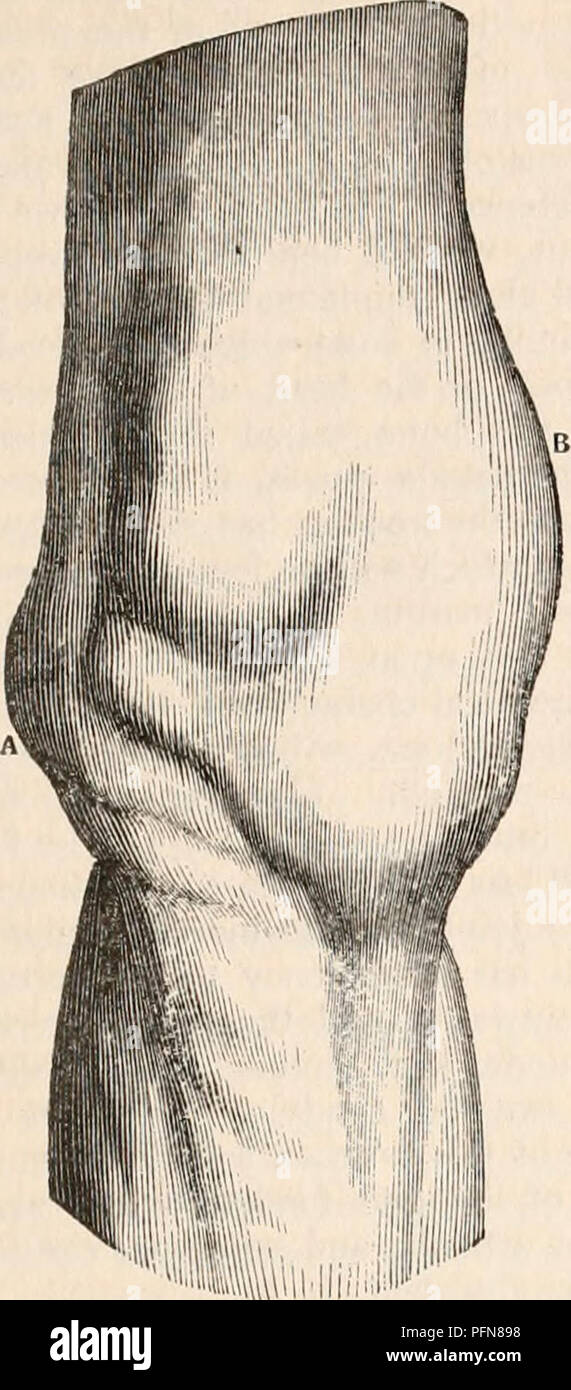 Innerer kondylus Stockfotos und -bilder Kaufen - Alamy