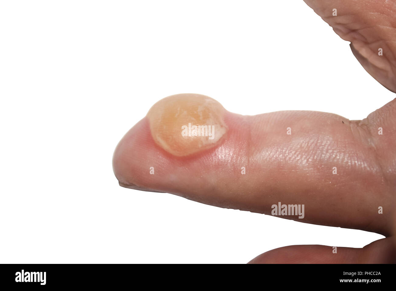 Burn scar hand -Fotos und -Bildmaterial in hoher Auflösung – Alamy