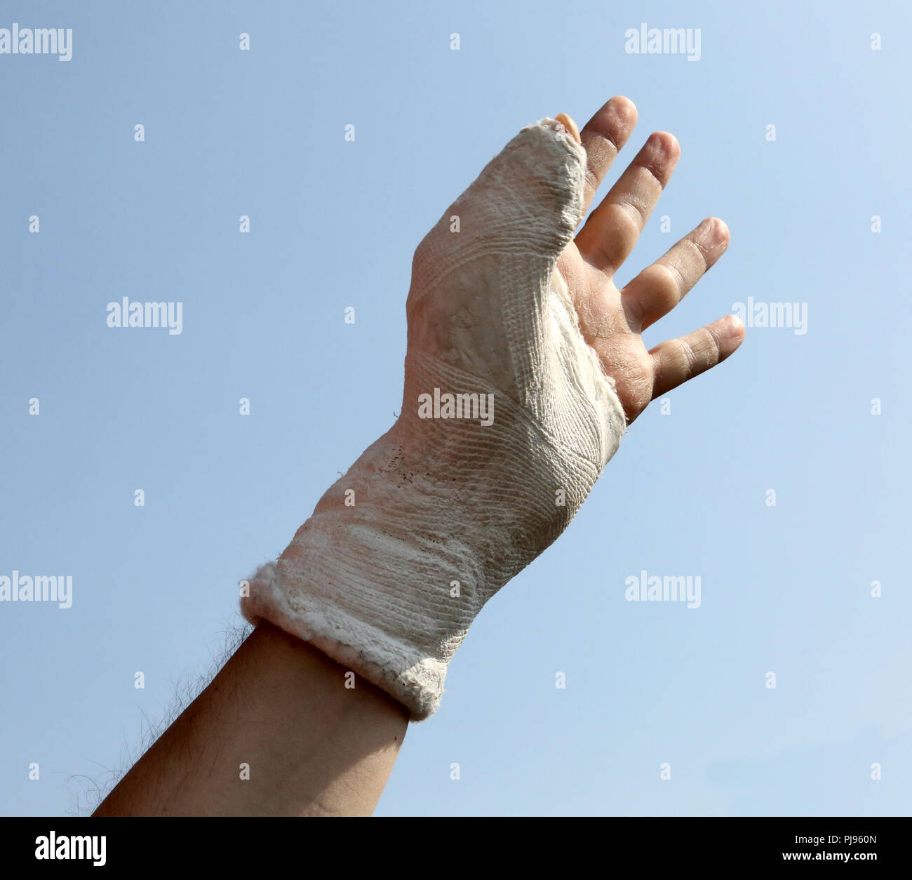 Die gebrochene Hand und der Gips im Krankenhaus mit dem Daumen nach ...