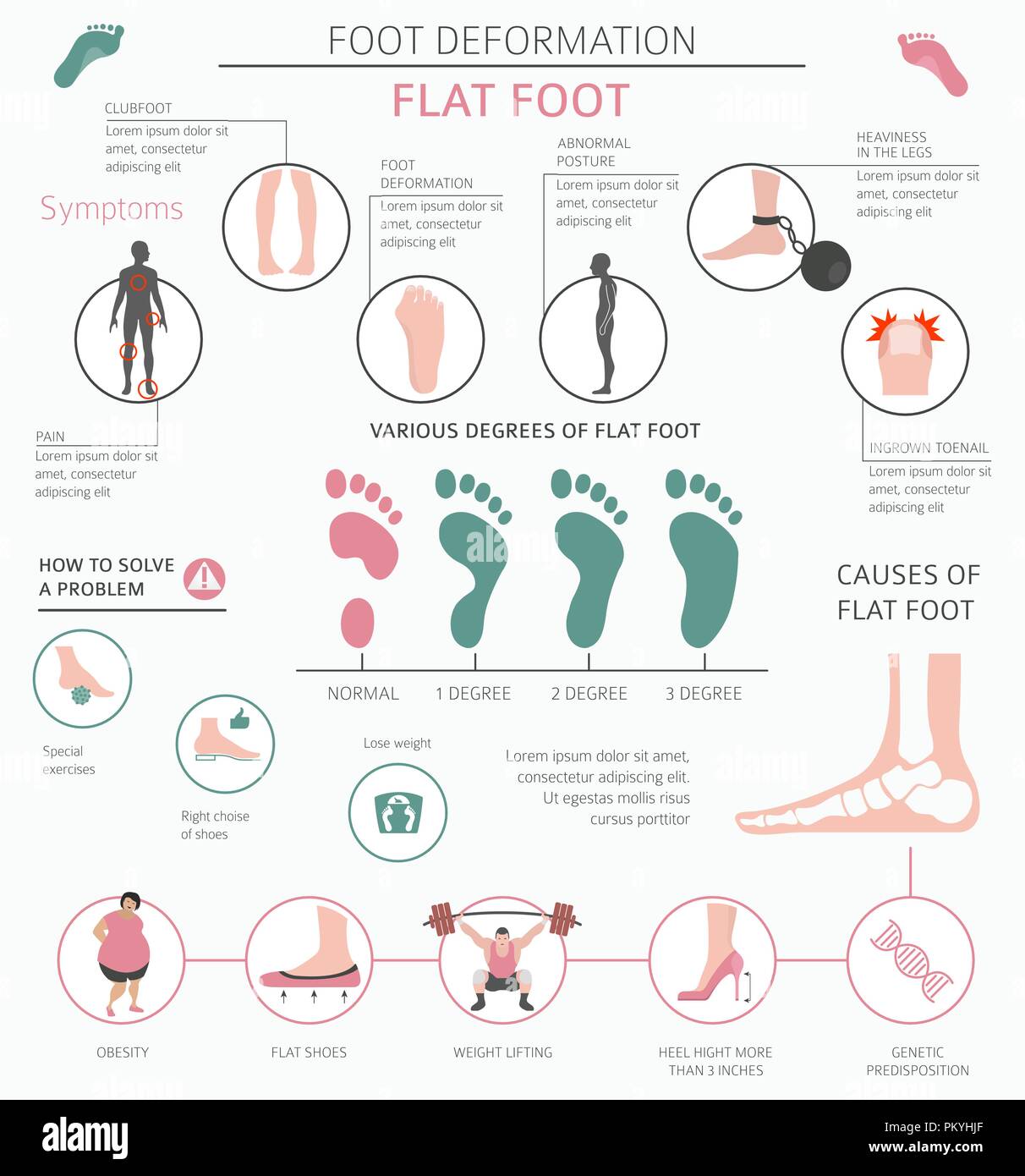 Fuß Verformung als medizinische Krankheit Infografik. Ursachen von Flat ...