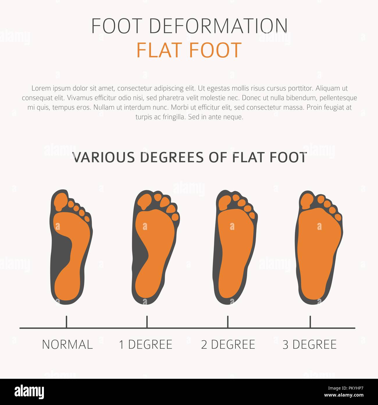 Flat Foot; Fuß; Infografik; Icon; Medizin; Zeh; Fuß Verformung ...