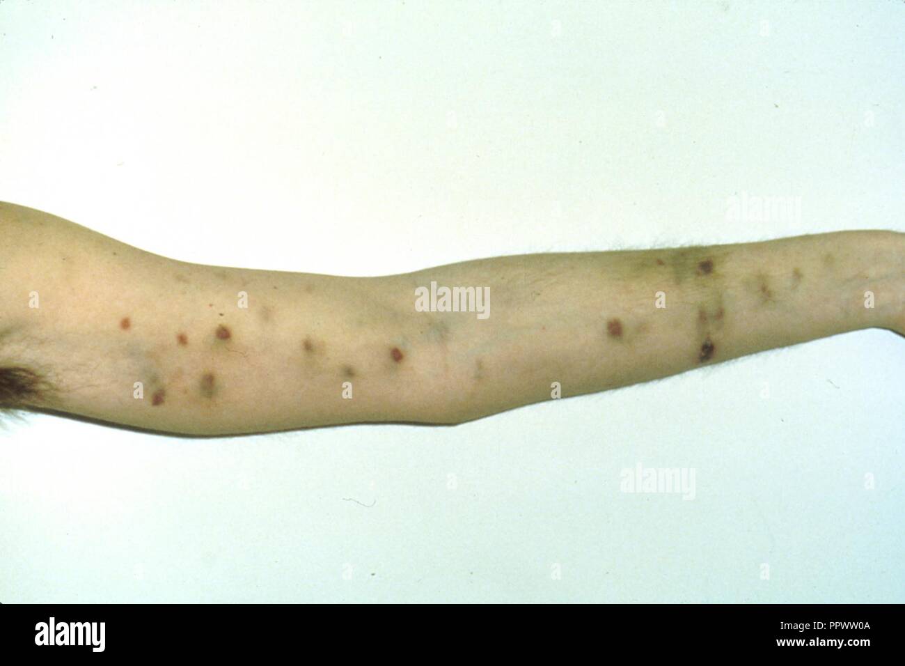 Kaposi's sarcoma -Fotos und -Bildmaterial in hoher Auflösung – Alamy