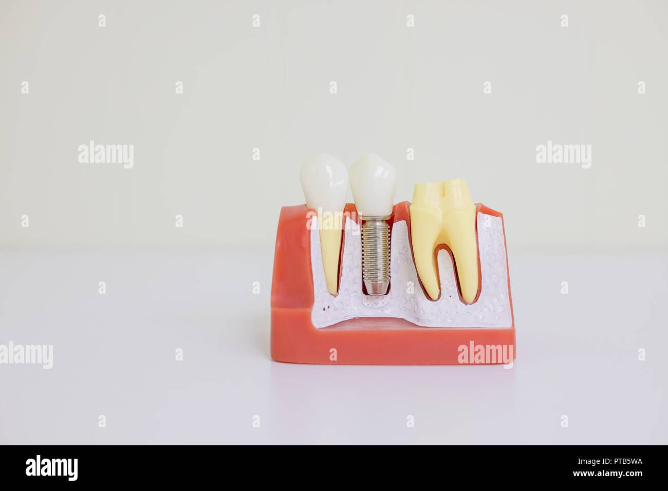 Dentsts zahnmedizinische Prothetik Zähne, Zahnfleisch, Wurzeln Lehre ...