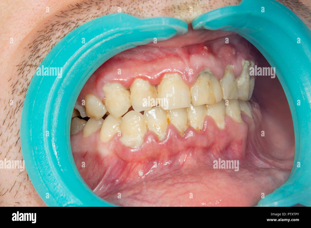 Plaque teeth -Fotos und -Bildmaterial in hoher Auflösung – Alamy