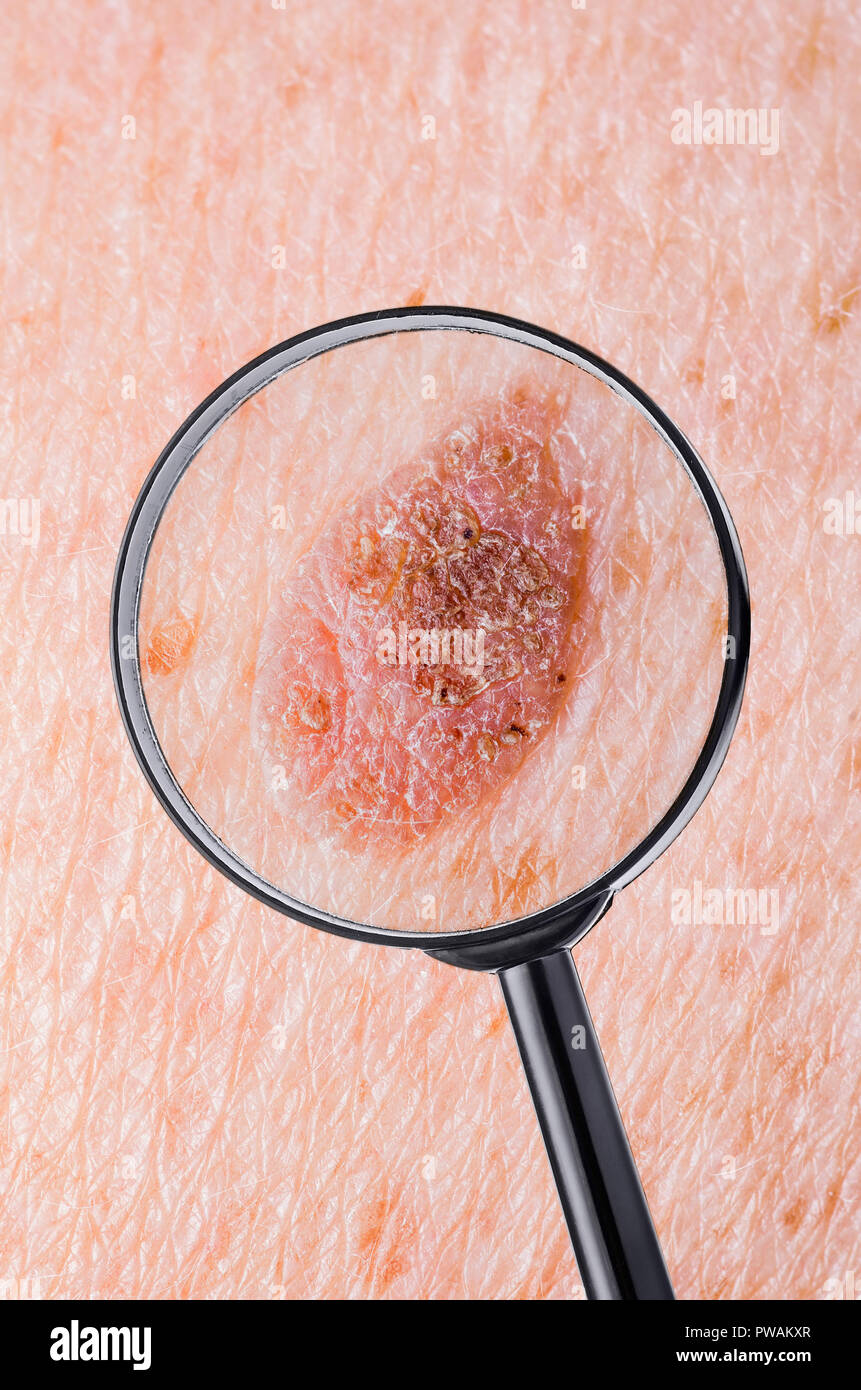 Gutartiger hauttumor -Fotos und -Bildmaterial in hoher Auflösung – Alamy