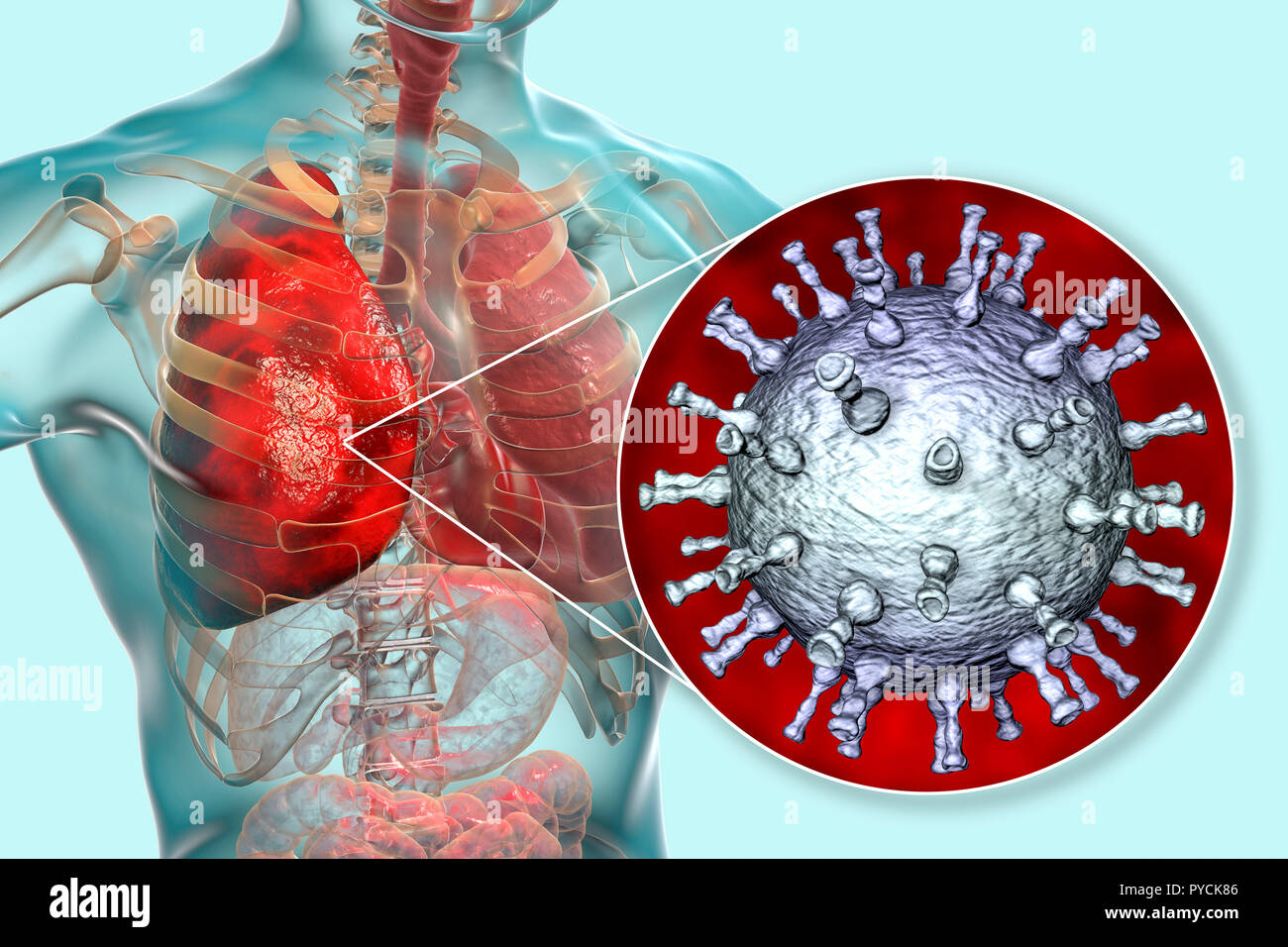 Lungenentzündung verursacht durch Varicella zoster Virus (VZV ...