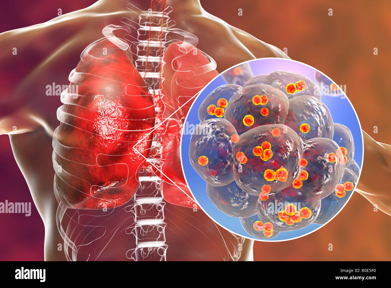 Staphylokokken infektion -Fotos und -Bildmaterial in hoher Auflösung ...