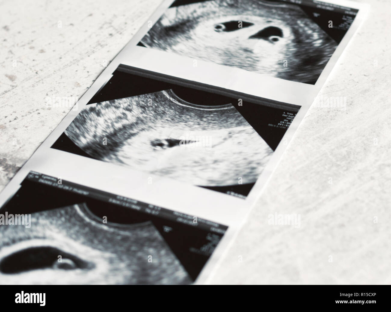 Ultraschallbild zwillinge -Fotos und -Bildmaterial in hoher Auflösung ...