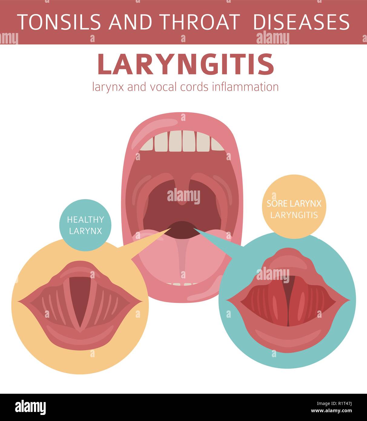 Mandeln HNO-Krankheiten. Laryngitis Symptome, Behandlung Icon Set ...
