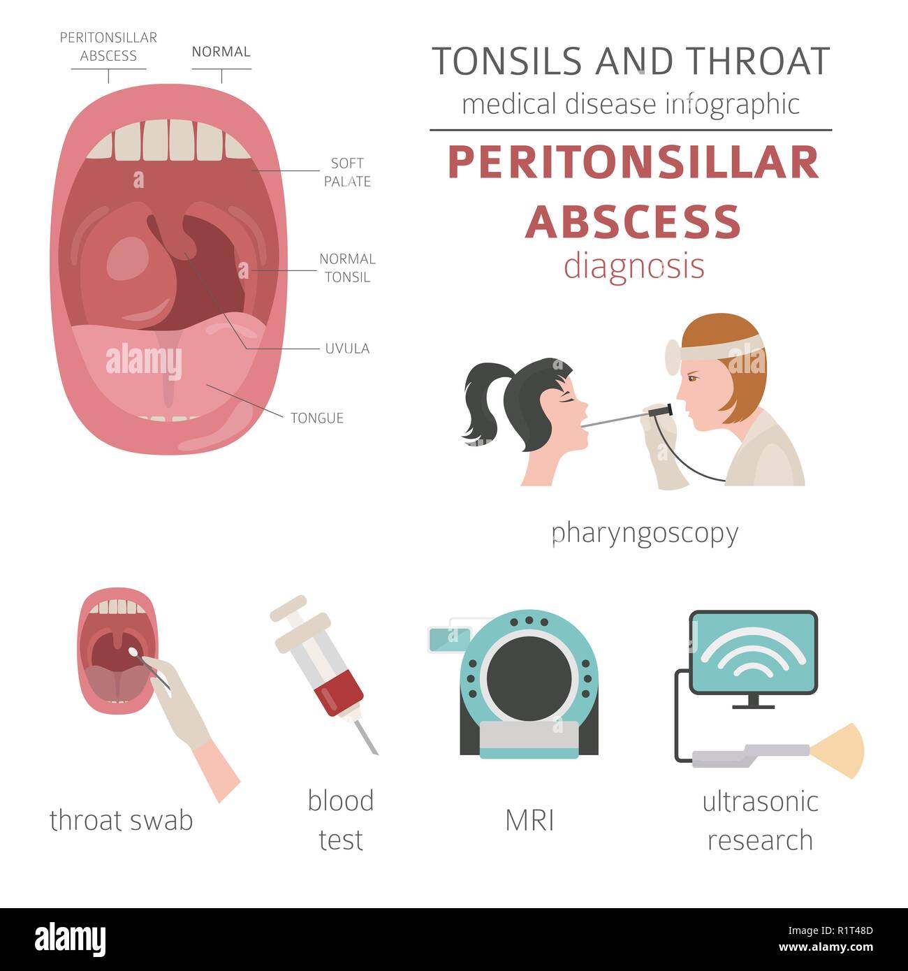 Mandeln HNO-Krankheiten. Peritonsillar Abszeß Symptome, Behandlung Icon ...
