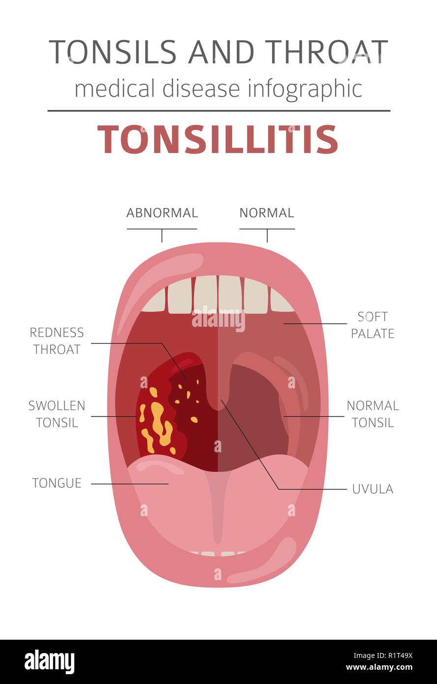 Mandeln HNO-Krankheiten. Mandelentzündung Symptome, Behandlung Icon Set ...