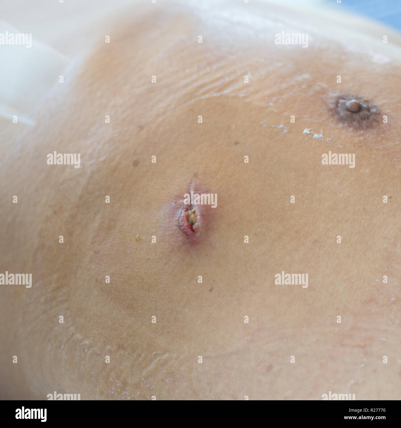 Infected wound -Fotos und -Bildmaterial in hoher Auflösung – Alamy