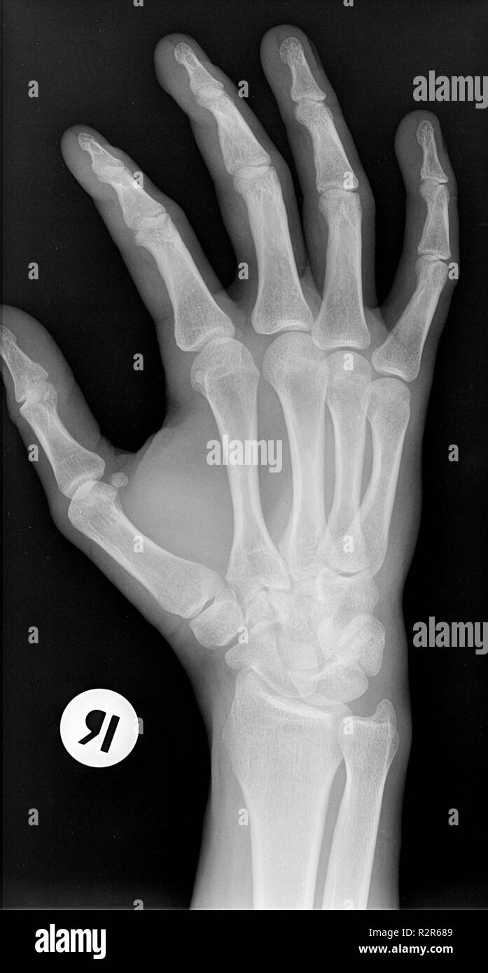 Hand knochen -Fotos und -Bildmaterial in hoher Auflösung – Alamy